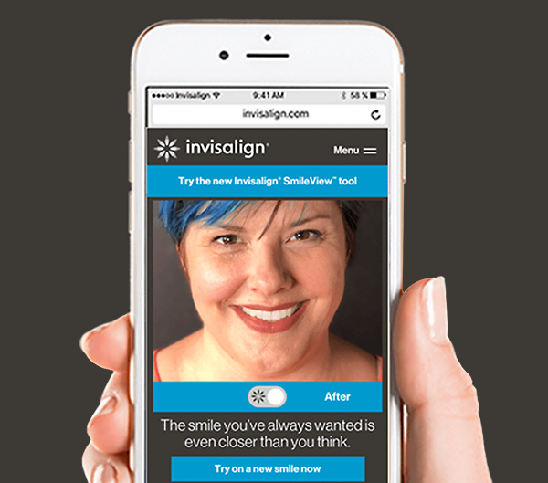 Invisalign Smile View - Fresh Orthodontics